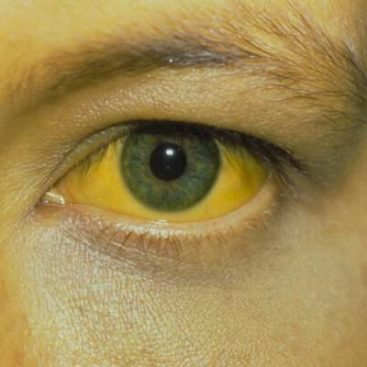 Hepatitis A Outbreaks in the United States Linked to Food or Food ...